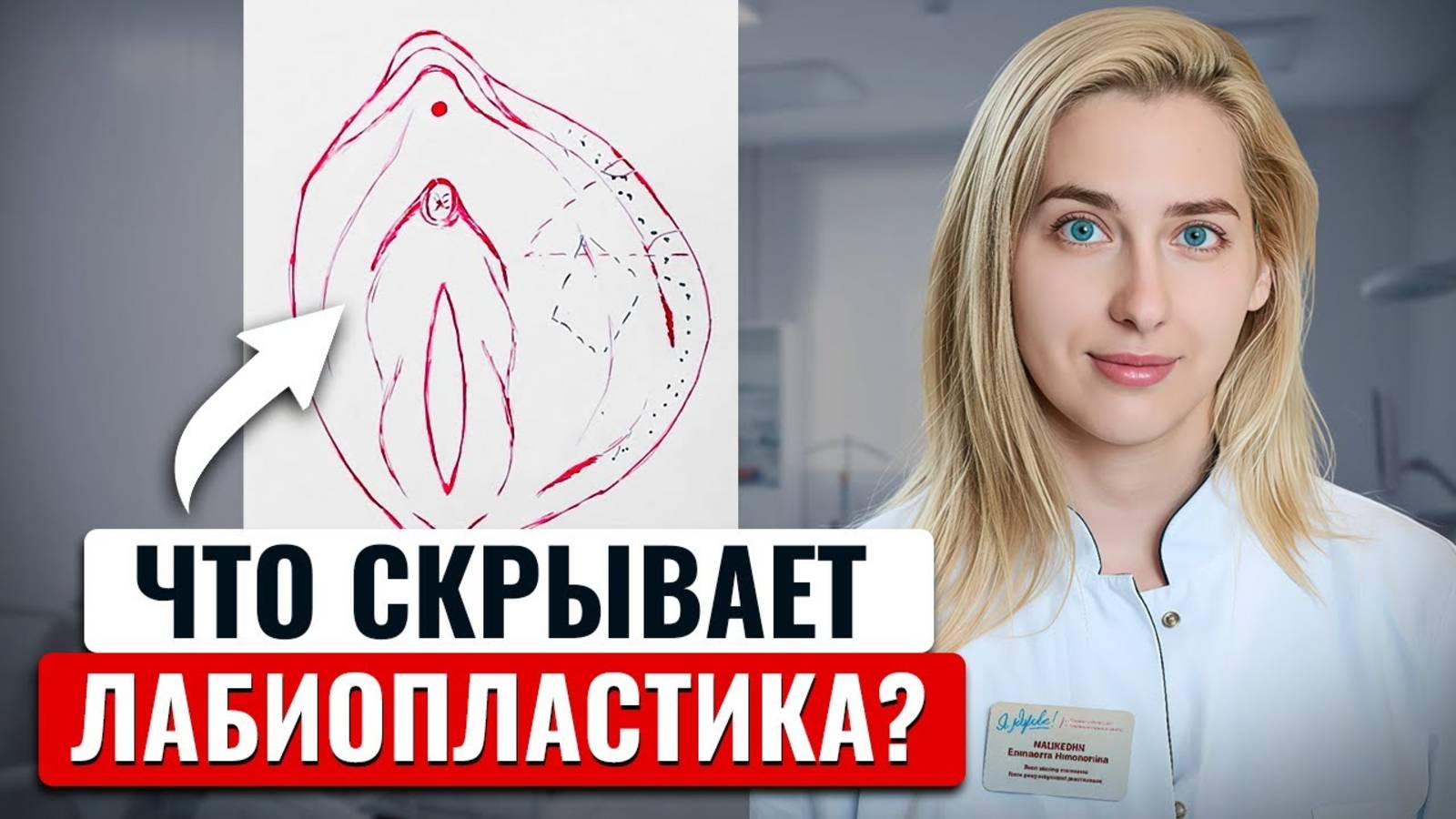 Что скрывает лабиопластика?