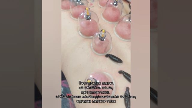 Постановка пиявок на область почек