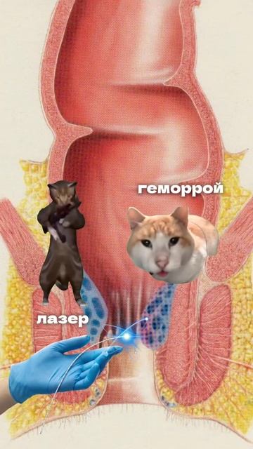 Реклама операции по удалению геморроя