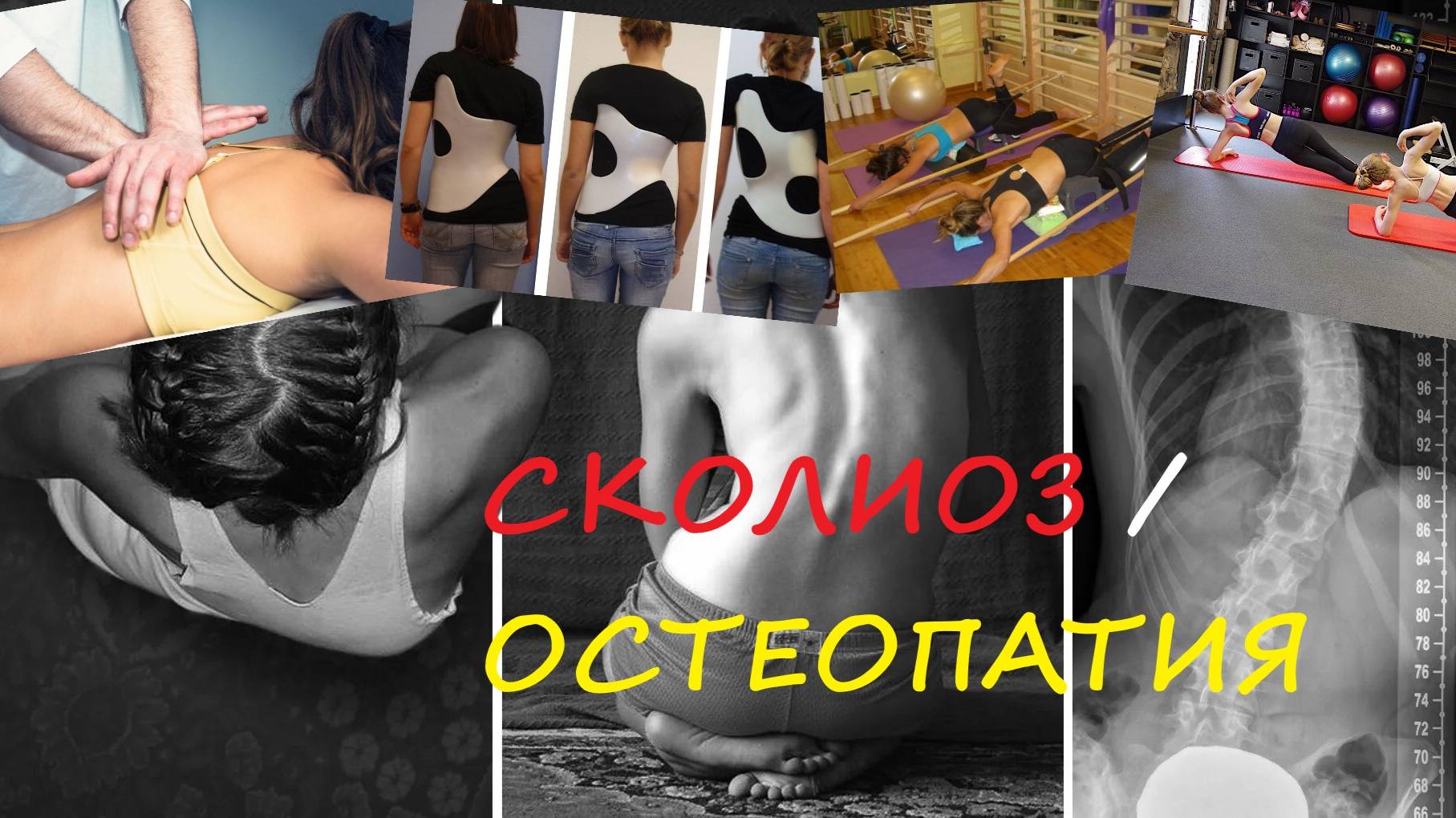 Правда о остеопатической коррекции сколиоза за чашкой кофе. ч 2.