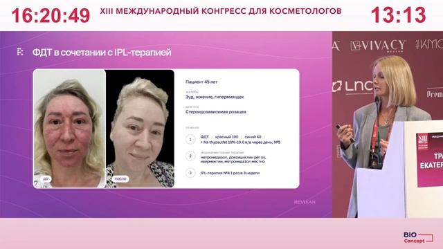 Трапчевская Екатерина. ФДТ REVIXAN – главный инструмент ускоренной реабилитации после СО2 лазера