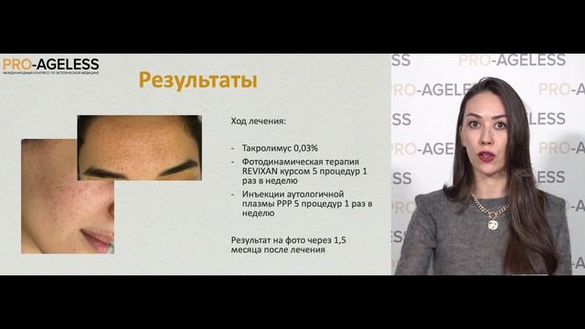 Практический опыт лечения гранулематозной формы розацеа с помощью ФДТ REVIXAN
