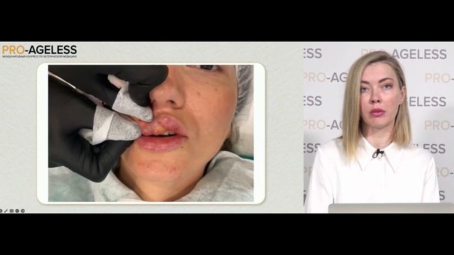 Работа с постинъекционными осложнениями с применением фотодинамической терапии REVIXAN