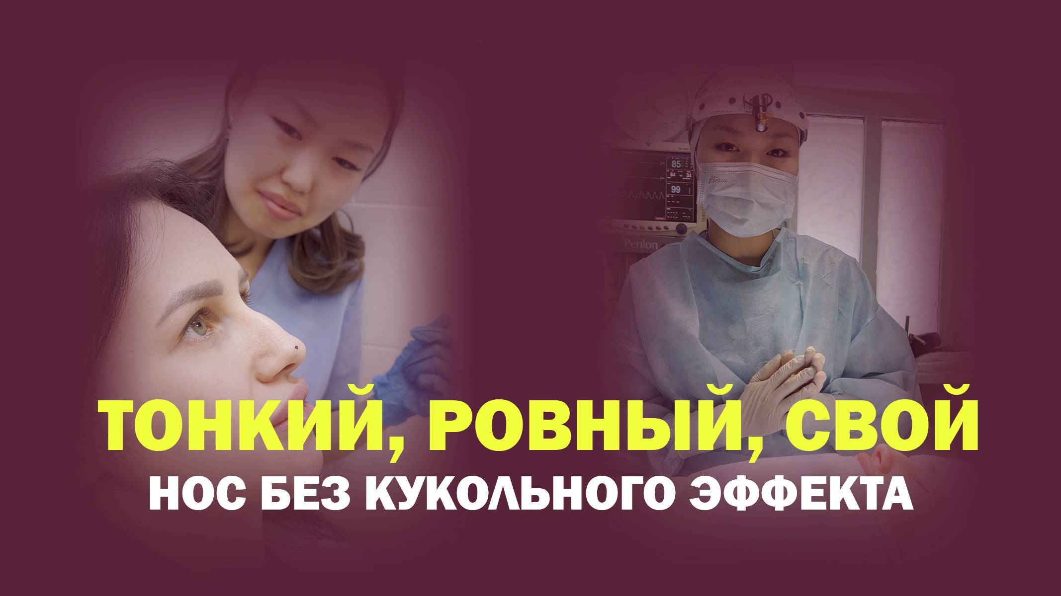 Ринопластика после септопластики: гармония без перегибов