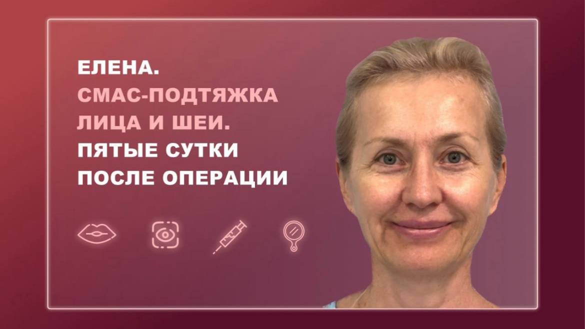 Елена. СМАС-подтяжка лица и шеи. Пятые сутки после операции