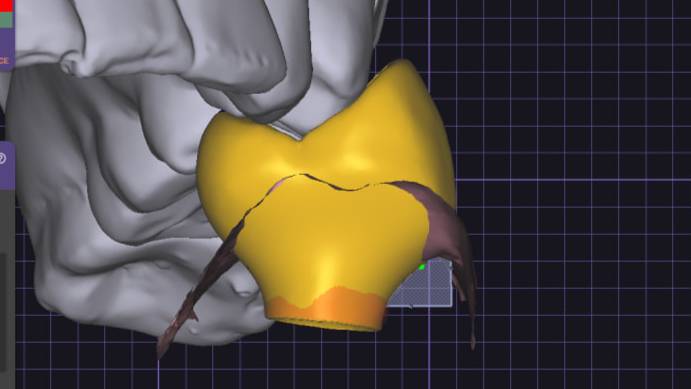 Правила отдавливания десны в ортопедических конструкциях.