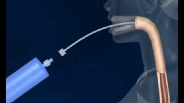 Внутрижелудочный баллон