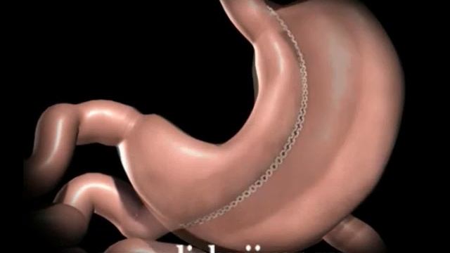 Продольная резекция желудка (СЛИВ)