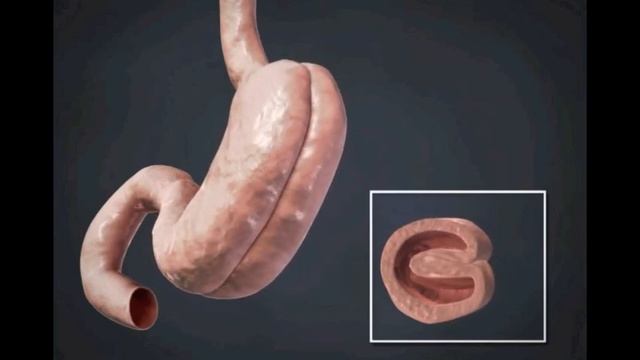 Гастропликация (СЛИВ 2)