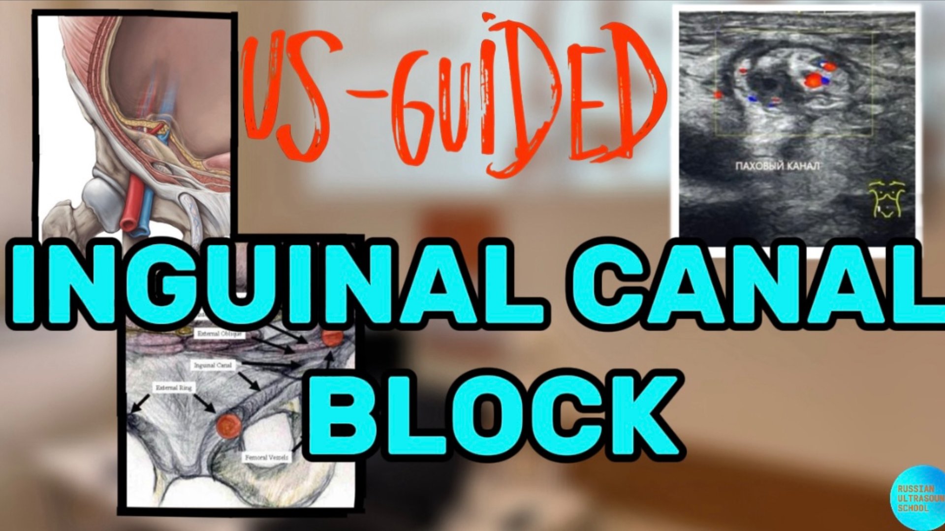 БЛОКАДА ПАХОВОГО КАНАЛА