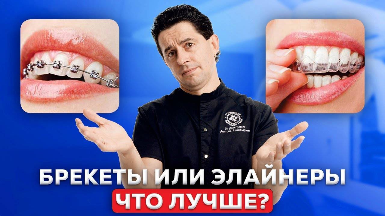 Брекеты или Элайнеры? Разбираем, Что Лучше!