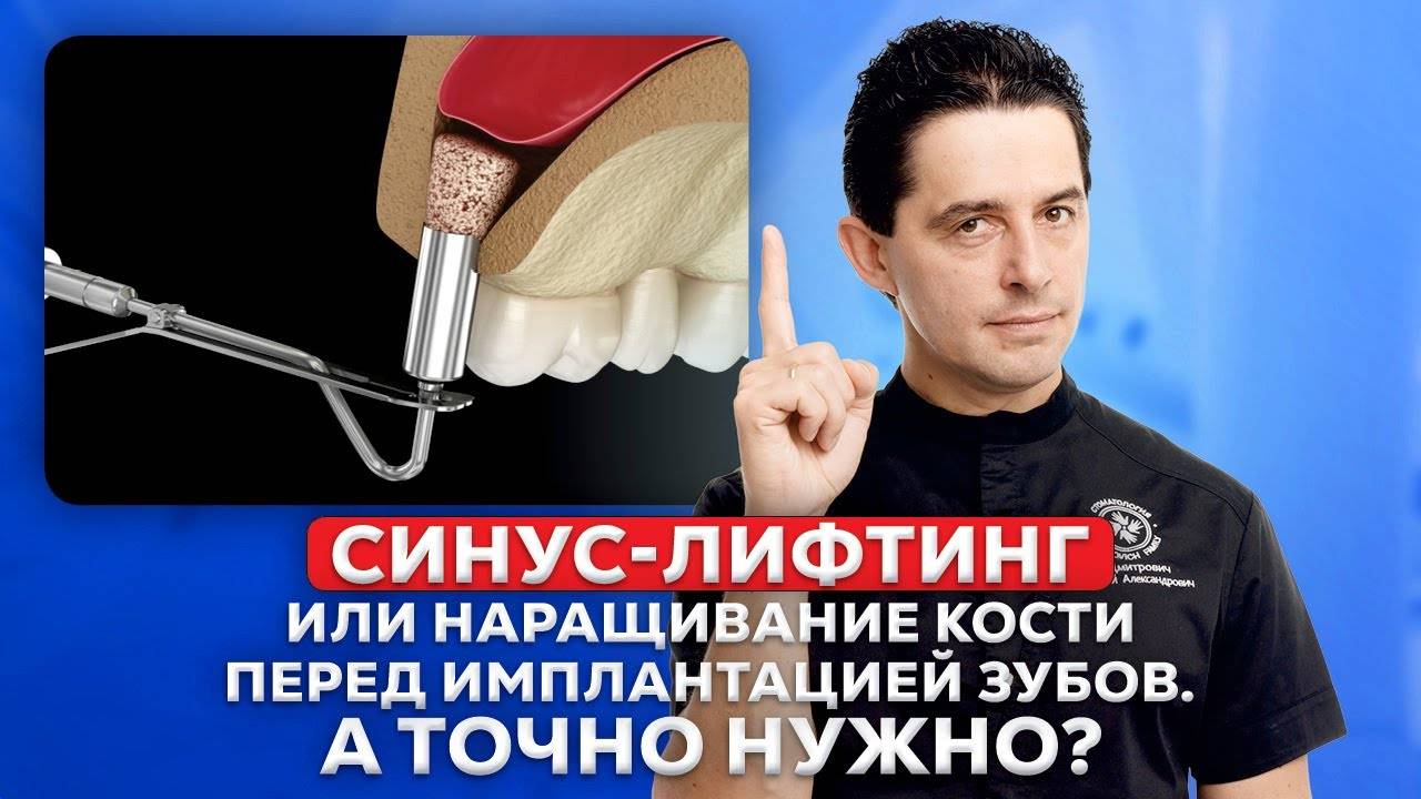 Синус-лифтинг: Как вернуть красивую улыбку!