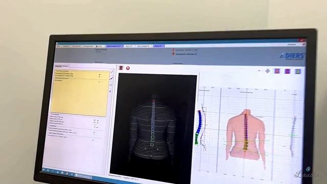 Диагностика заболеваний позвоночника с использованием оптического топографа ДИРС