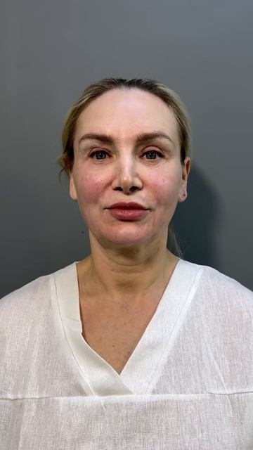 Комплексное омоложение лица, до и после пластической операции