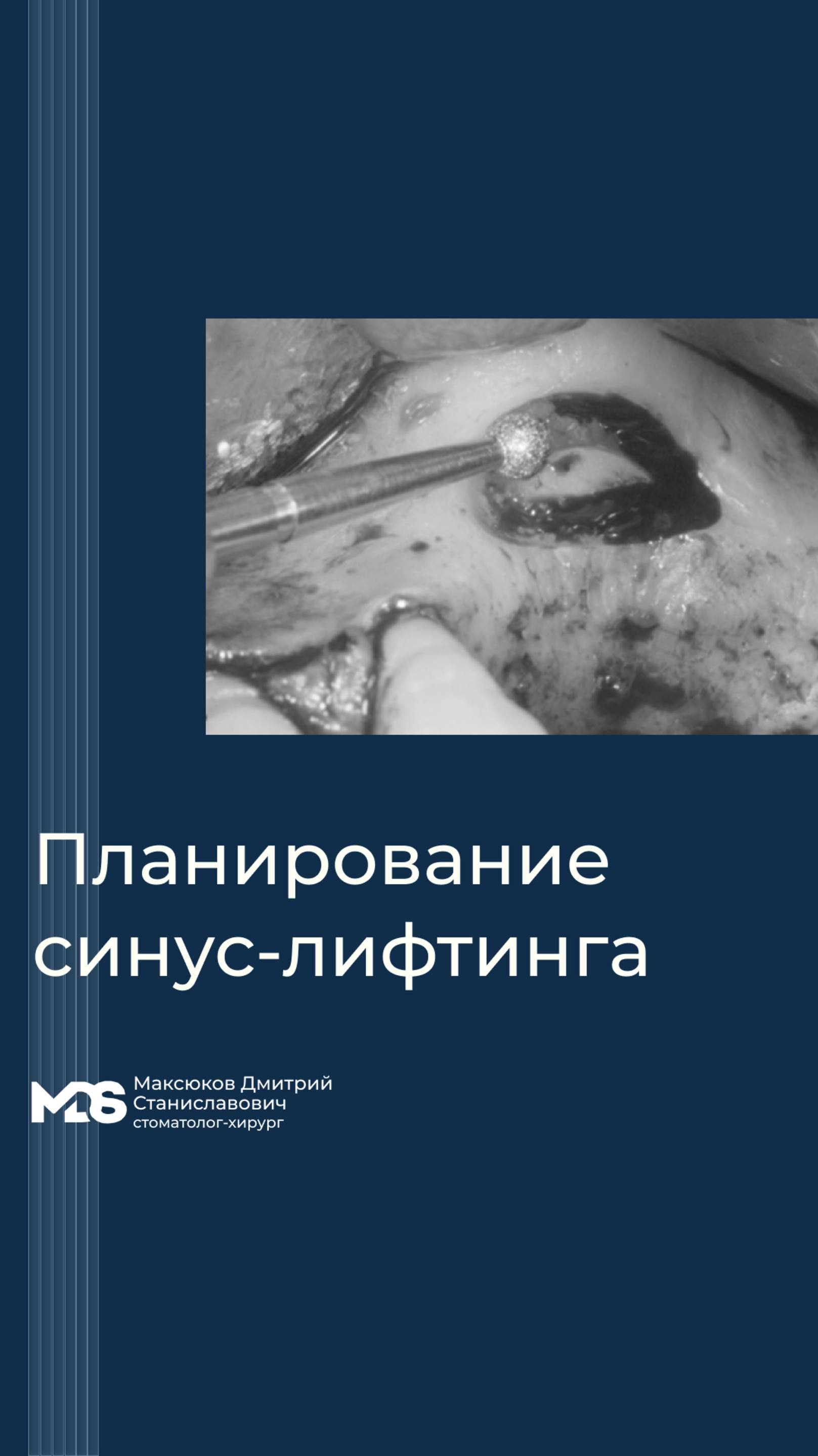 Панирование латерального синус-лифтинга