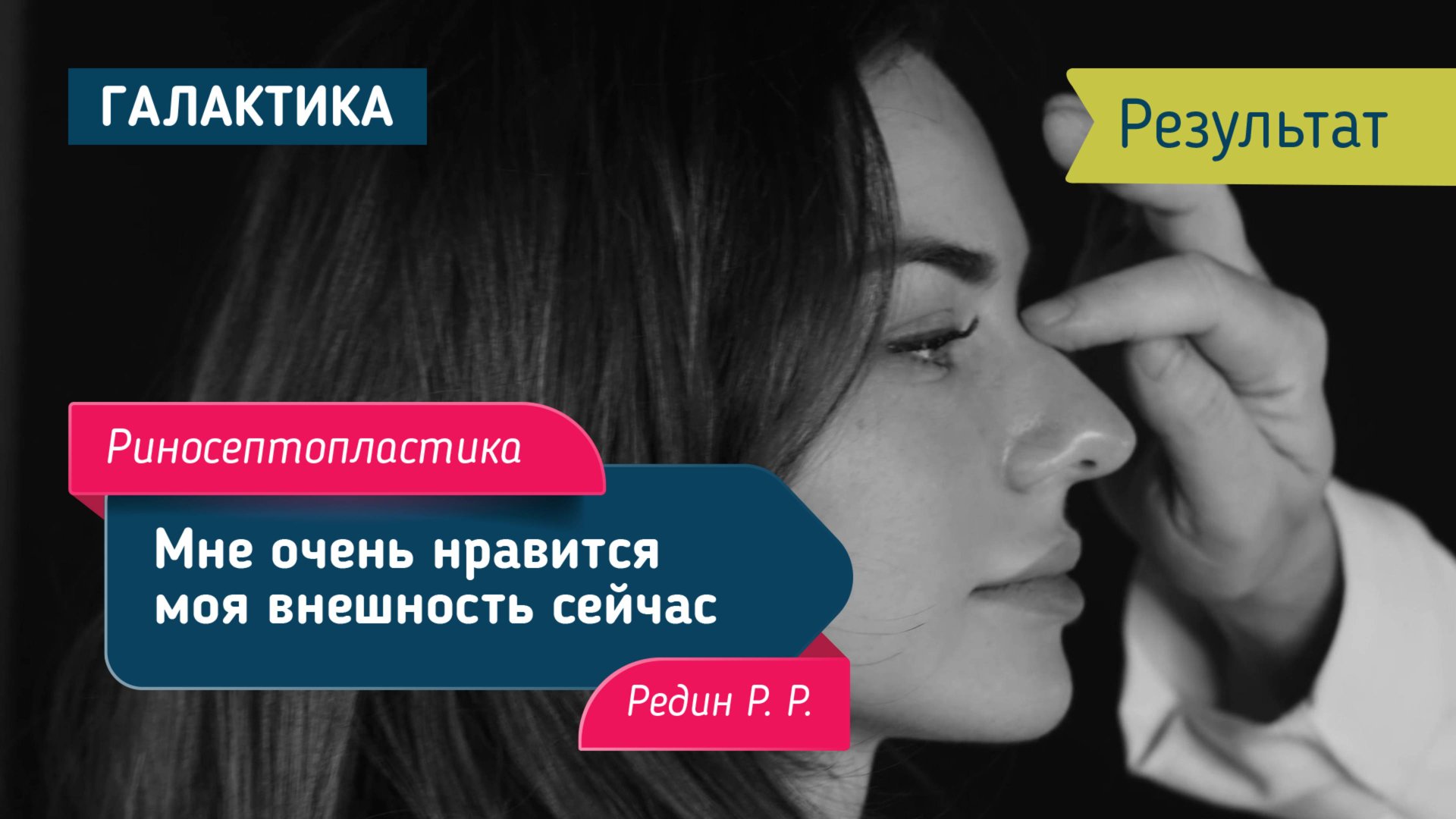 Риносептопластика с устранением горбинки и проблем с дыханием | Спустя 6 месяцев у Редина Романа