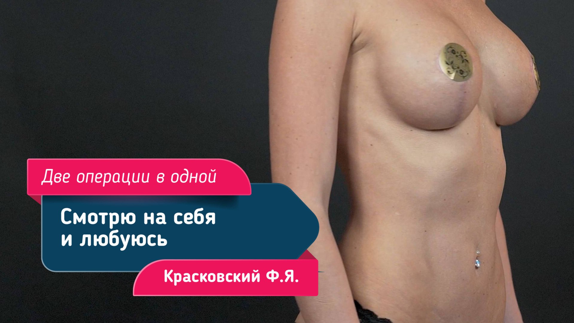 Липоскульптура и повторная маммопластика | Коррекция груди и бёдер у Красковского Фёдора Яновича