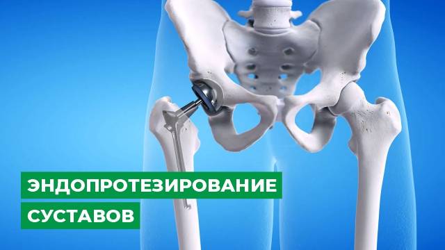 Эндопротезирование суставов