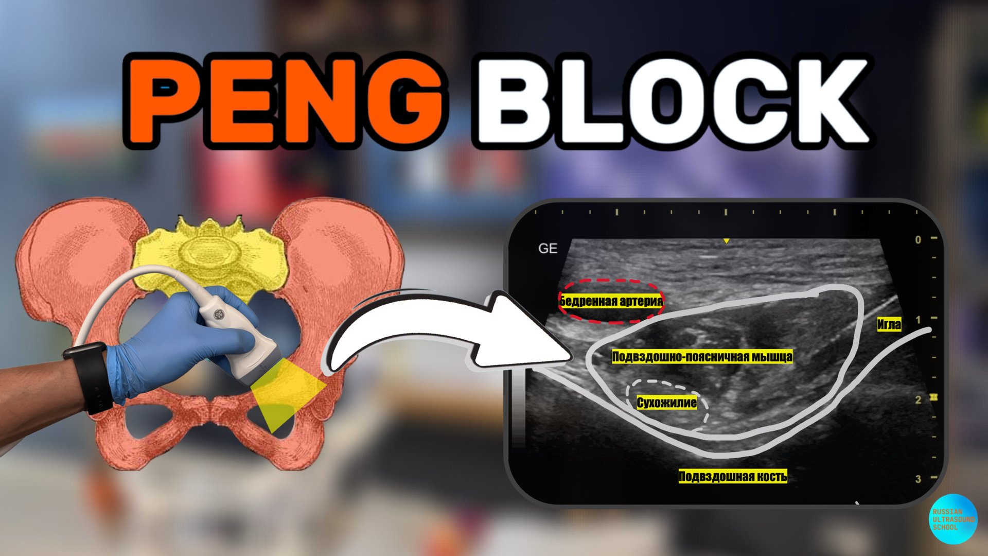 PENG block
#узинавигация #regionalanesthesia #лечениеболи #PENG #курсыузи #практикум #painmanagment