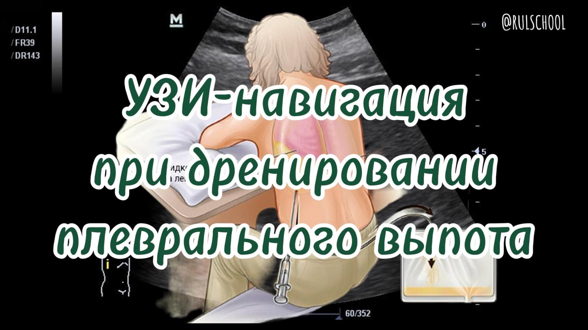 ДРЕНИРОВАНИЕ ПЛЕВРАЛЬНЫХ ПОЛОСТЕЙ С УЗИ-НАВИГАЦИЕЙ ПОД ХОРОШУЮ МУЗЫКУ
#ICU #ОРИТ #узилегких
