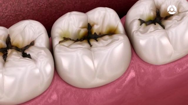 Час здоровья. Кариес и его последствия