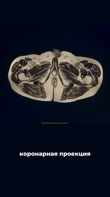 Опухоль правого бедра на снимках КТ