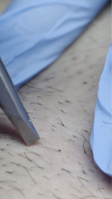 Электроэпиляция курсы Epilnice