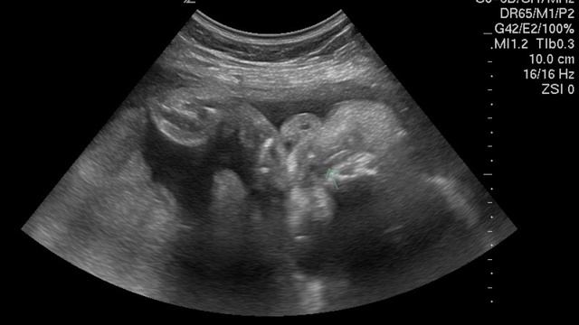 Плод 30 недель. Малыш жует и сосет в животике у мамы. 4D УЗИ.