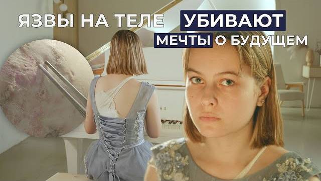 КОМЕДОНОВЫЙ НЕВУС ТЕЛА | История Саши Пакшиной