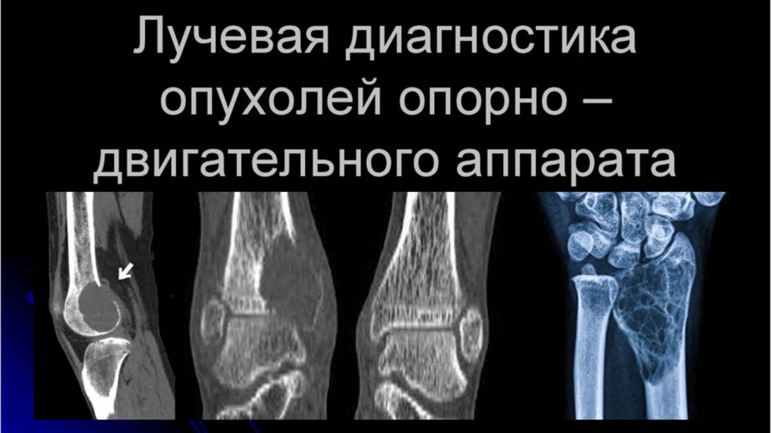 Лучевая диагностика опухолей костей (рентгенодиагностика, КТ, МРТ, РНД)