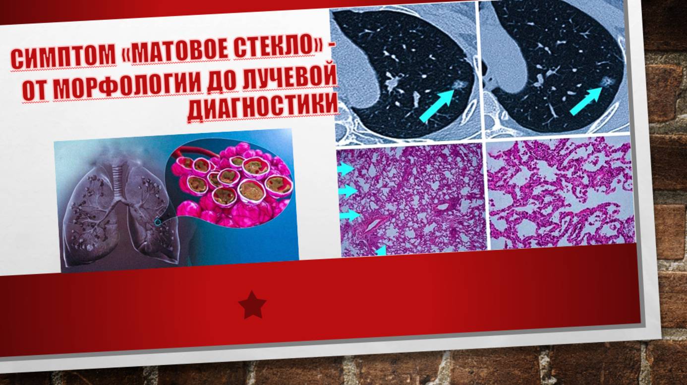 Симптом "Матовое стекло" - от морфологии к лучевой диагностике