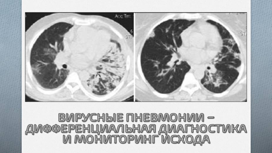 Вирусные пневмонии - дифференциальная диагностика и мониторинг исхода