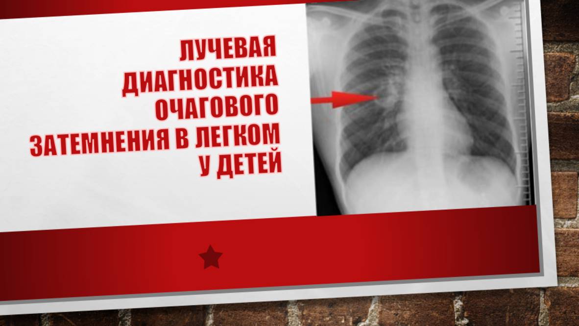 Лучевая диагностика очагового затемнения в легком у детей