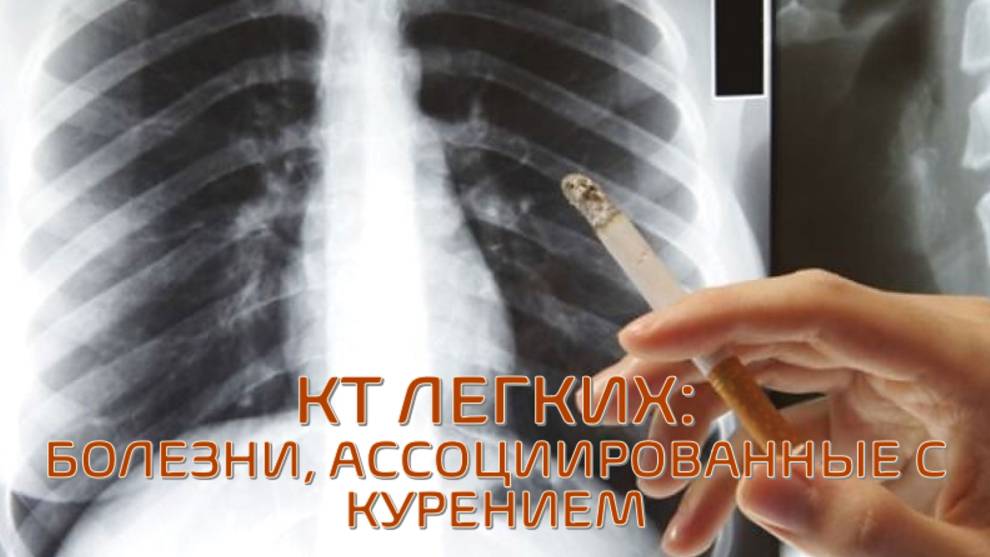 КТ легких-болезни, ассоциированные с курением
