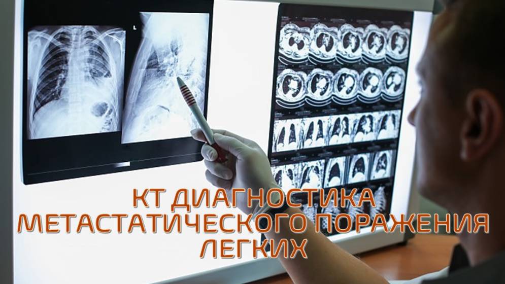 КТ диагностика метастатического поражения лёгких