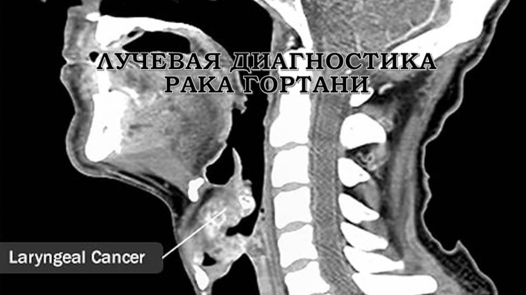 Лучевая диагностика рака гортани