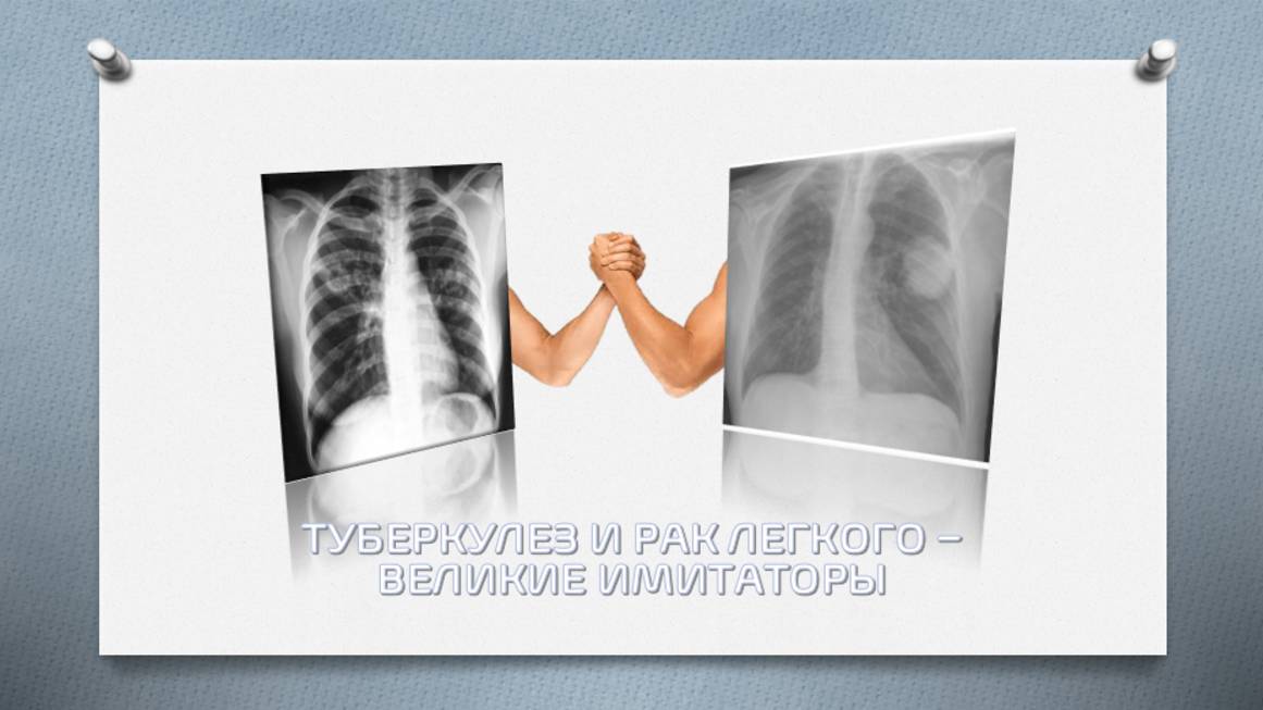 Великие имитаторы- туберкулез и рак легкого (на примере клинических случаев)