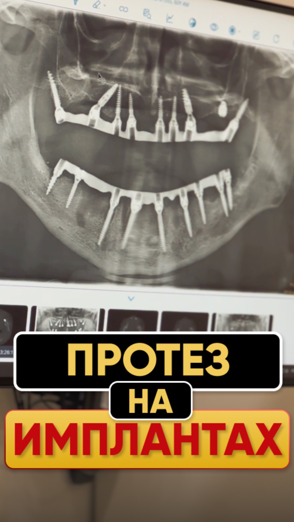 Быстрая реабилитация за 4 дня: установка адаптационного протеза на имплантах| Стабилизация окклюзии