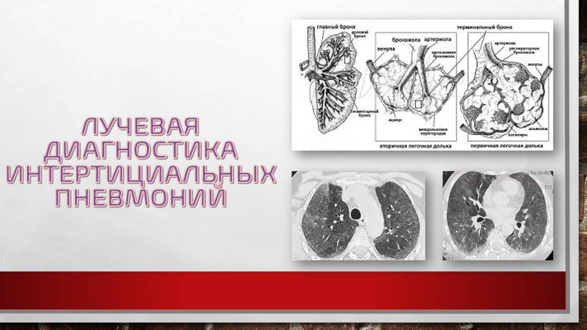 Лучевая диагностика интерстициальных пневмоний