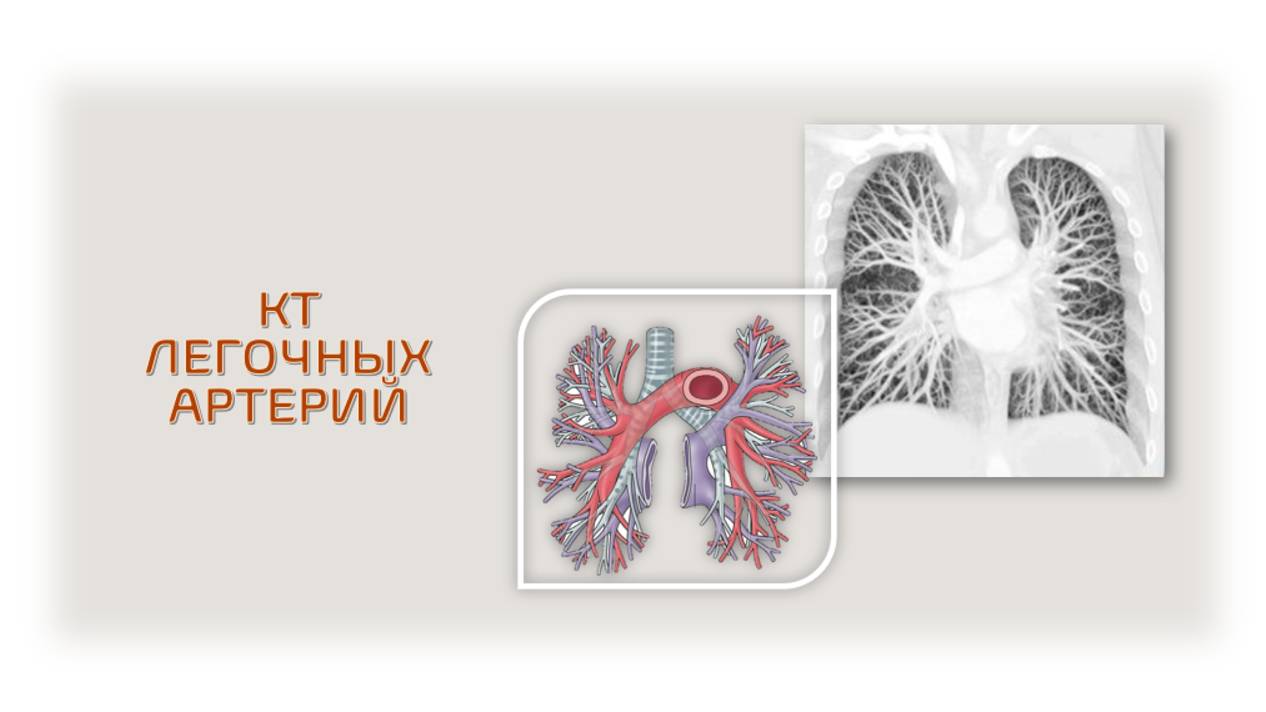 КТ ЛЕГОЧНЫХ АРТЕРИЙ