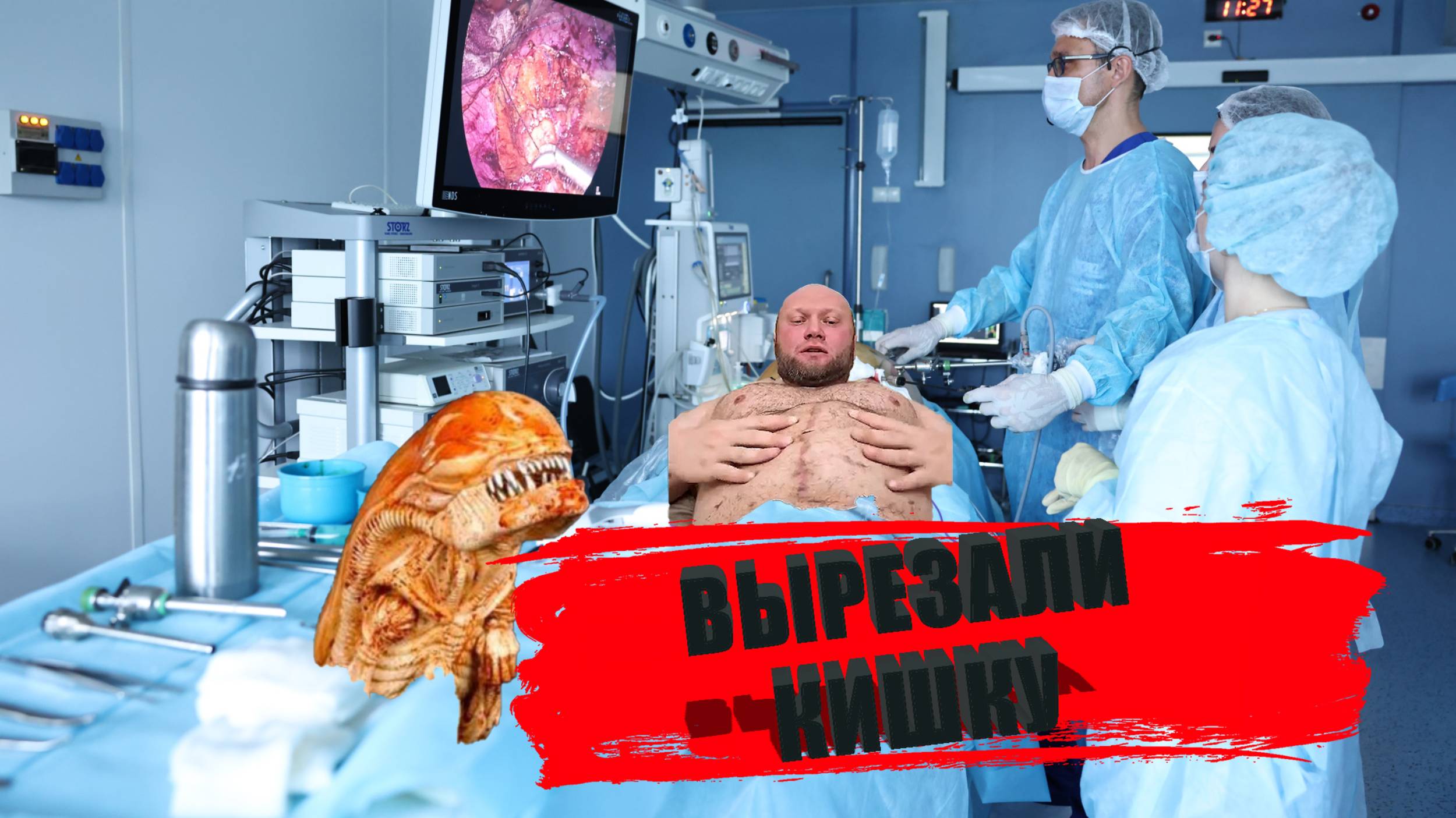 Операция Юрия Спасокукоцкого, к чему может привести увлечение бодибилдингом.