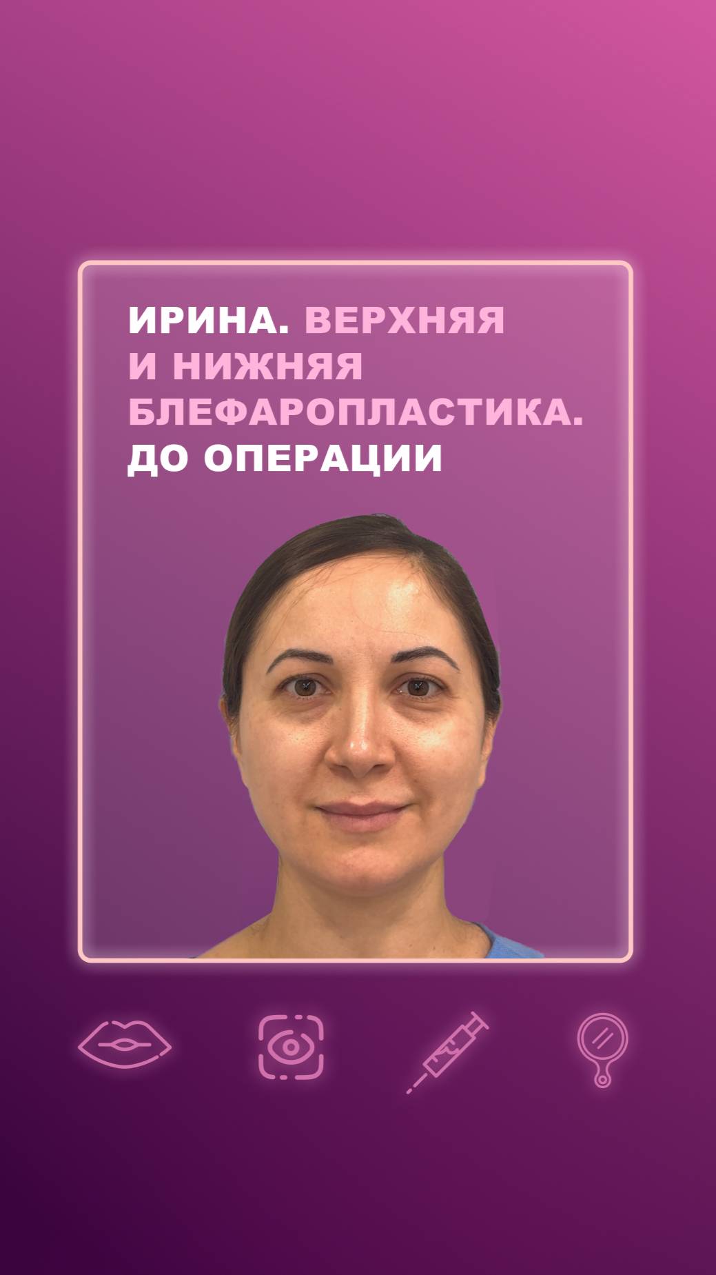 Ирина. Верхняя и нижняя блефаропластика. До операции