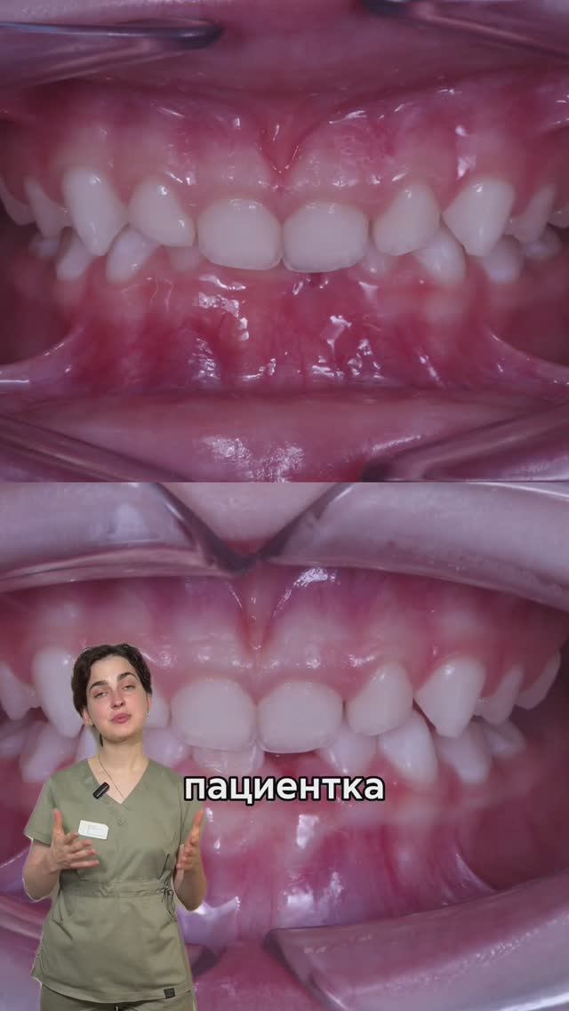 ⚕️ Неправильное смыкание зубов. Клинический случай