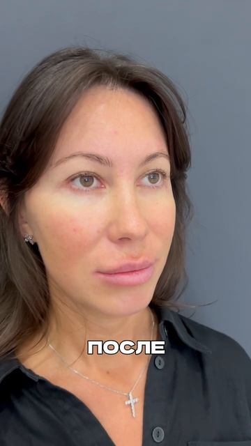 #нижняя_блефаропластика: маленькая операция — большой результат