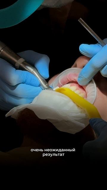 Эффектное снятие брекет-системы