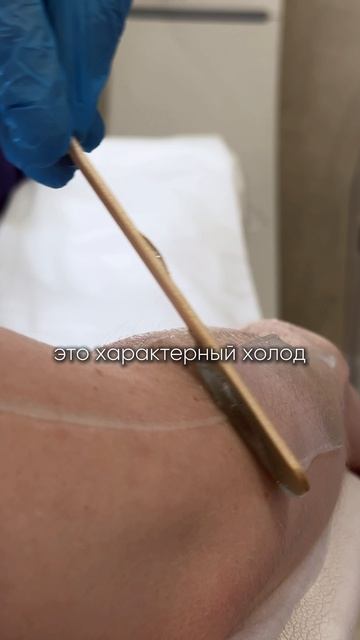 Лазерная эпиляция