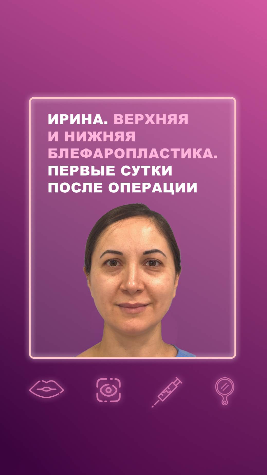 Ирина. Верхняя и нижняя блефаропластика. Первые сутки после операции