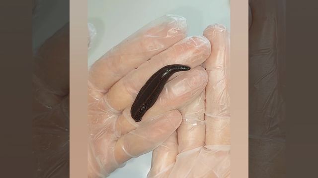 Постановка пиявок на пояснично-крестцовый отдел