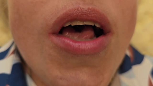 Идиопатическая рото-лицевая дистония. Как выглядит? Работа со взрослыми. Лого-фасциальный метод.