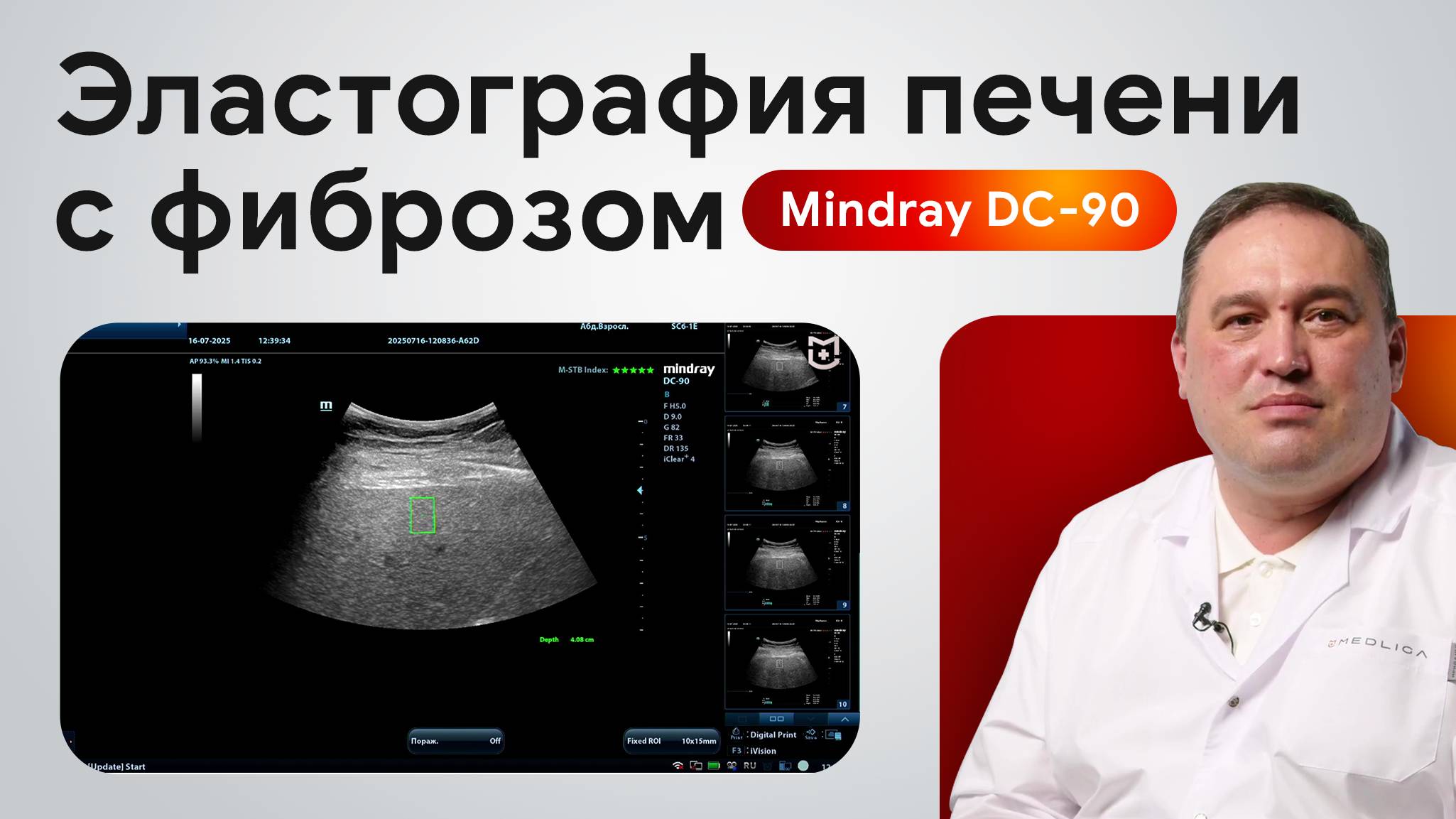 Эластография печени на Mindray DC-90: диагностика фиброза